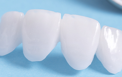 Natural-Looking Veneers | Aura Dental Spa, Dr Phillips, FL